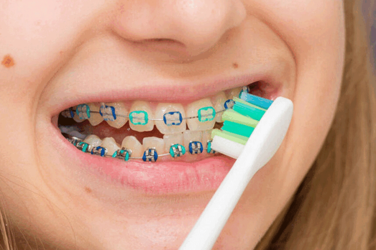 Een beugel: Wie draagt de kosten en wat betekent het voor je kind ...